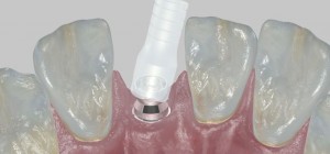 3.0 DYNAMIC ABUTMENT FOR PRAMA IMPLANTS | Dynamic Abutment Solutions EN