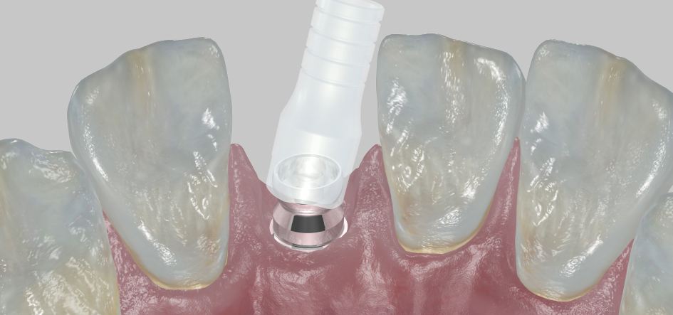 3.0 DYNAMIC ABUTMENT FOR PRAMA IMPLANTS | Dynamic Abutment Solutions EN