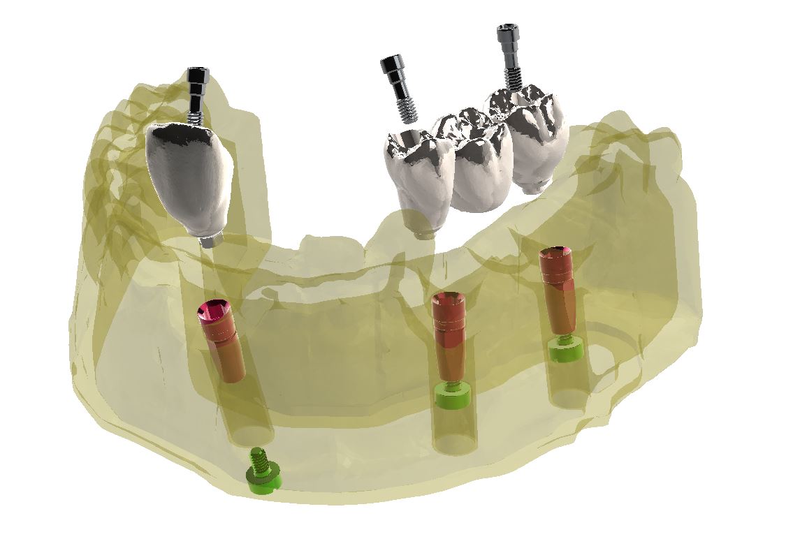 DIGITAL ANALOG | Dynamic Abutment Solutions EN
