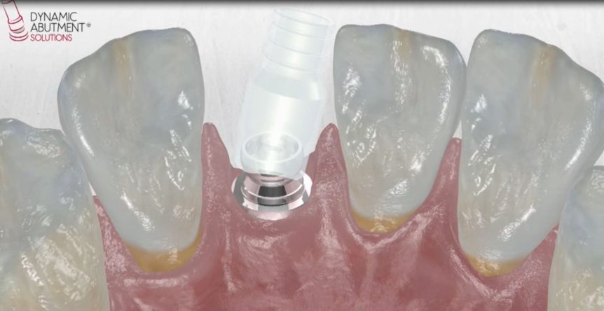 DYNAMIC ABUTMENT® 3.0 - Dynamic Abutment Solutions EN