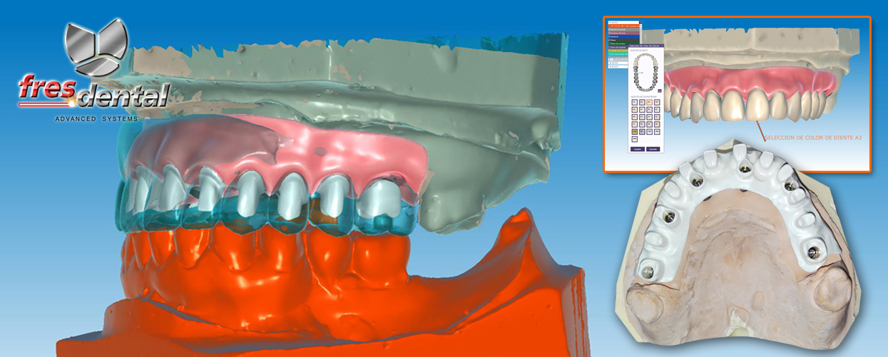 DOCUMENTED CASE: HYBRID PROSTHESIS ON NATURAL TEETH MADE OF “PEEK ...