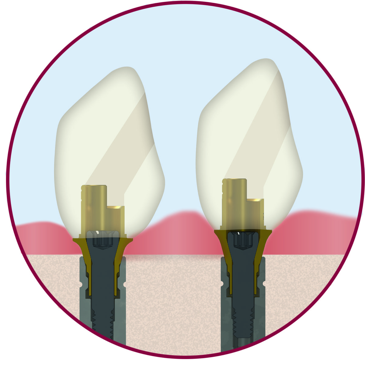 DYNAMIC TIBASE® FOR DIFFERENT GINGIVAL MARGINS LEVEL | Dynamic Abutment ...