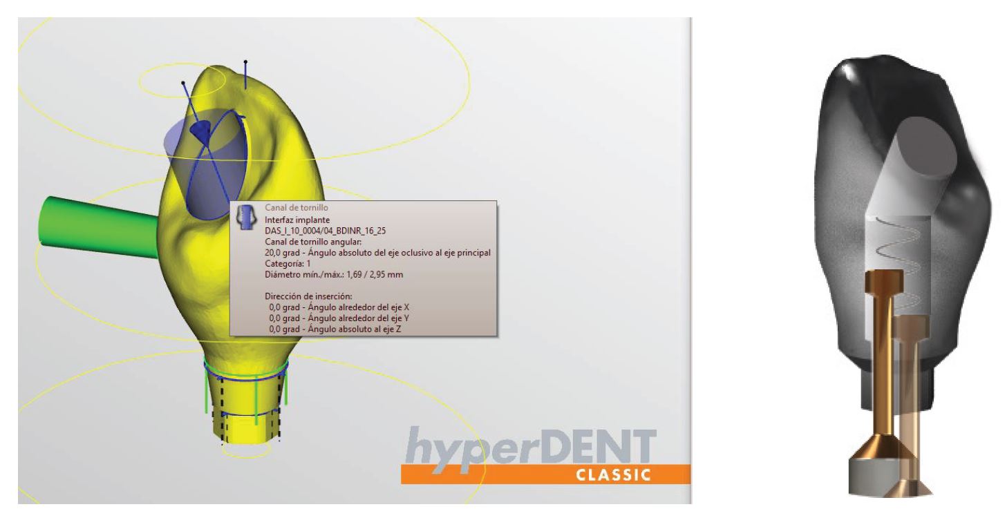 DMTONE VALIDATED BY HYPERDENT® | Dynamic Abutment Solutions EN
