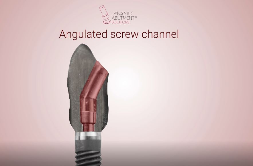 The most aesthetic angulated screw channel on the market! | Dynamic Abutment Solutions EN