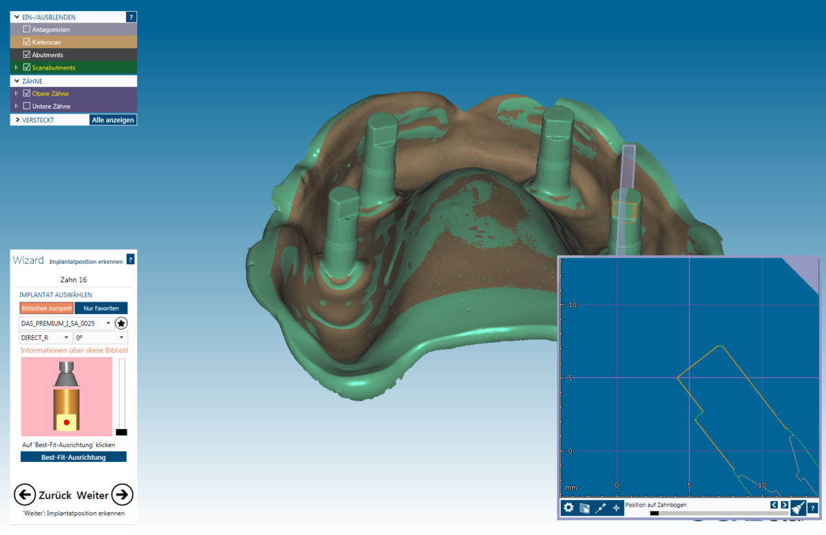 ScAnalog: A NEW CONCEPT OF WORK | Dynamic Abutment Solutions EN