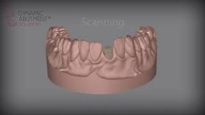TIBASE GINGIVAL OPTIONS | Dynamic Abutment Solutions EN