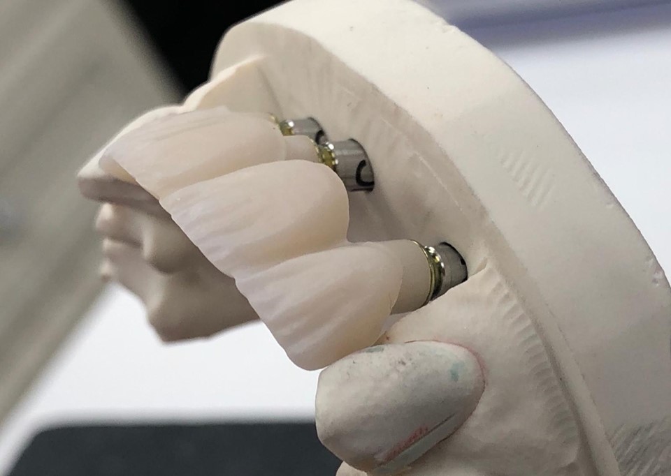 DYNAMIC TIBASE CASE | Dynamic Abutment Solutions EN