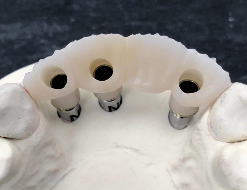 DYNAMIC TIBASE CASE | Dynamic Abutment Solutions EN
