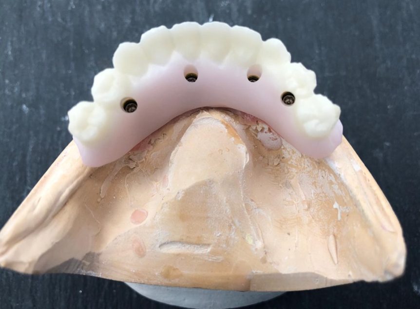 Case with our Tibase® | Dynamic Abutment Solutions EN