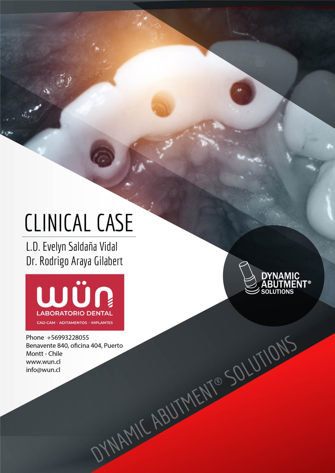 CASE WITH TIBASE AND DAS LIBRARIES | Dynamic Abutment Solutions EN