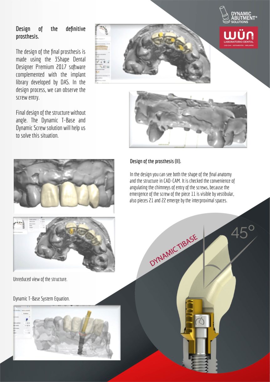 CASE WITH TIBASE AND DAS LIBRARIES | Dynamic Abutment Solutions EN