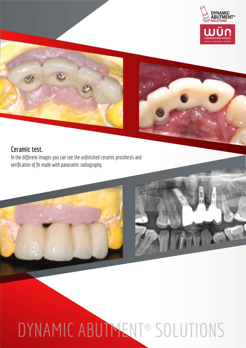 CASE WITH TIBASE AND DAS LIBRARIES | Dynamic Abutment Solutions EN