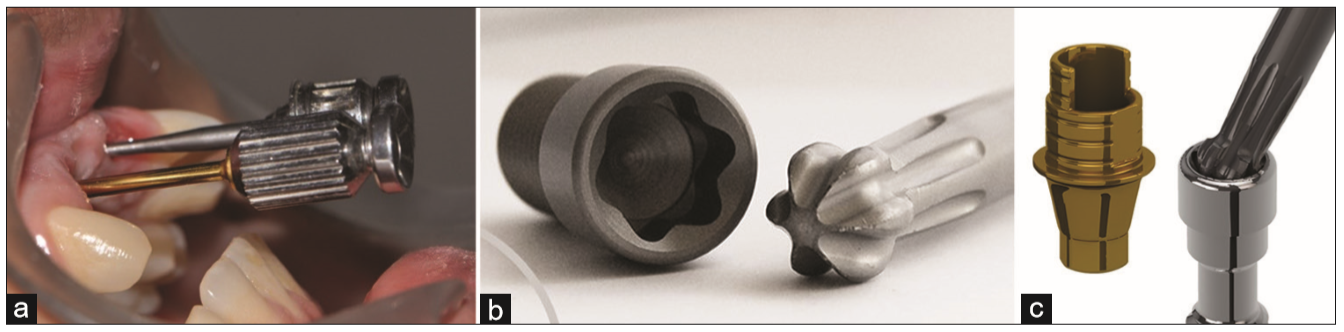 NEW CASE: Graftless solution for multiple unfavorably placed implants ...