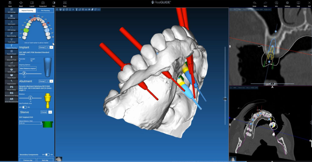 DYNAMIC ABUTMENT SOLUTIONS LIBRARIES FOR 3DIEMME REAL GUIDE | Dynamic ...