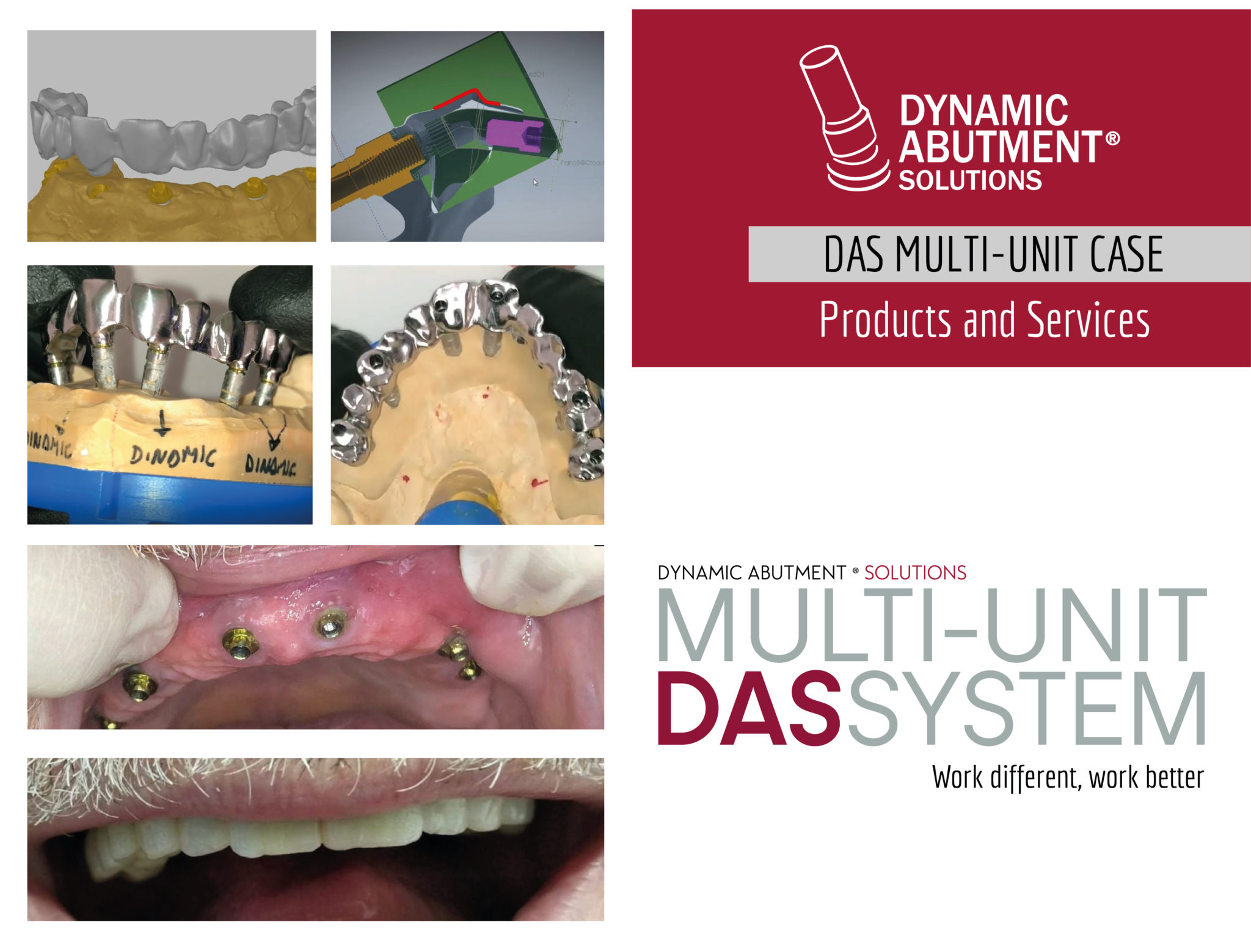 Case studies Archives - Dynamic Abutment Solutions EN