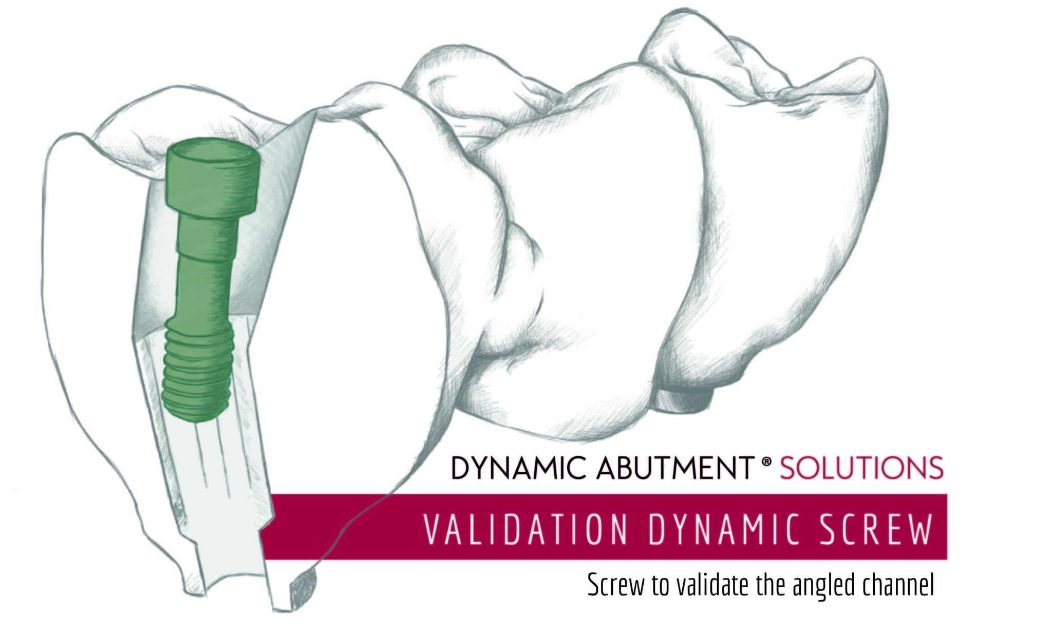 VALIDATION DYNAMIC SCREW | Dynamic Abutment Solutions EN VALIDATION DYNAMIC SCREW | Dynamic Abutment Solutions EN