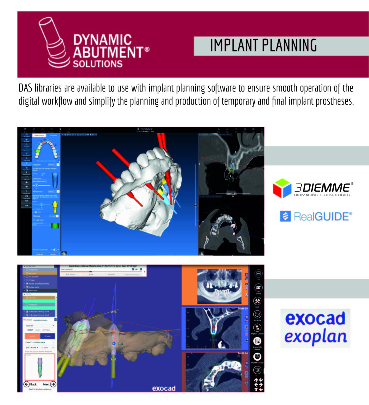DAS LIBRARIES FOR IMPLANT PLANNING SOFTWARE | Dynamic Abutment Solutions EN