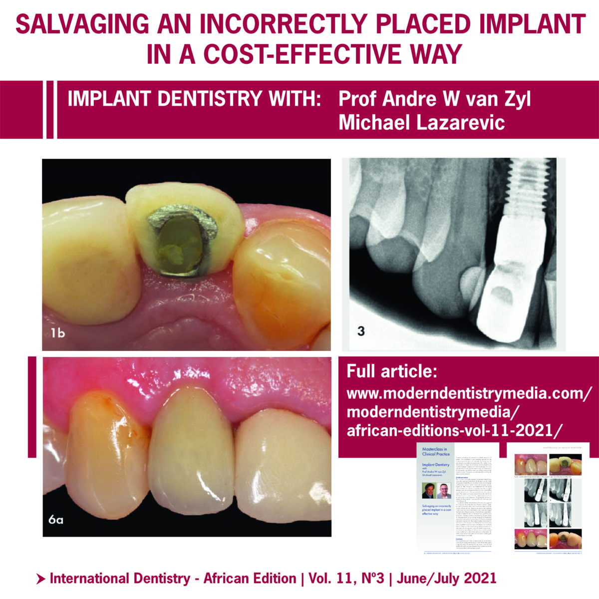 Case “How to recover a badly placed implant in a cost-effective way ...