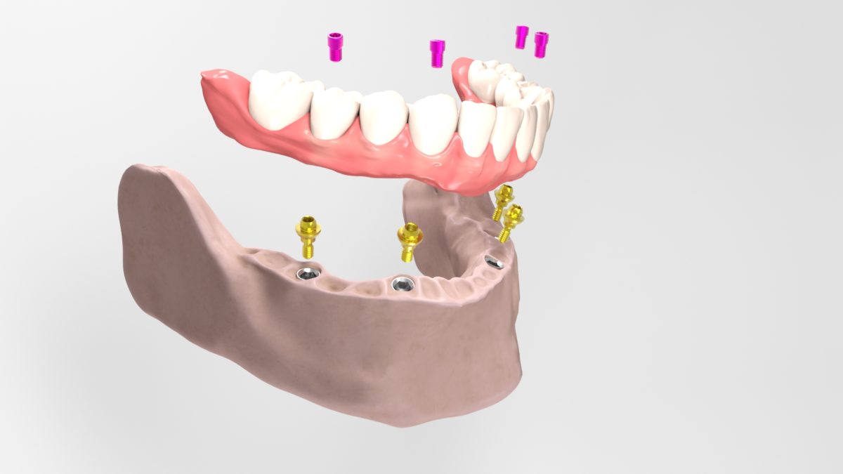 MULTI-UNIT WORKFLOW 1 | Dynamic Abutment Solutions EN