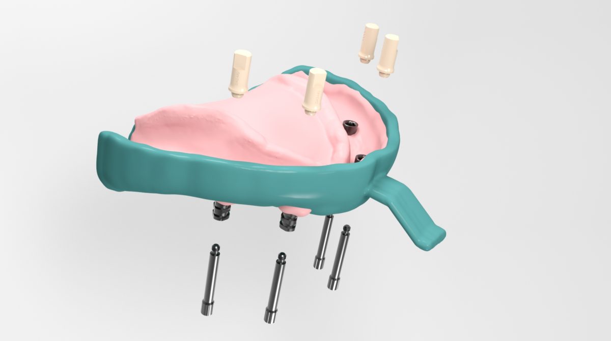 06_01 Cubeta + Impression Coping + ScAnalog + Tornillo Imp.coping ...