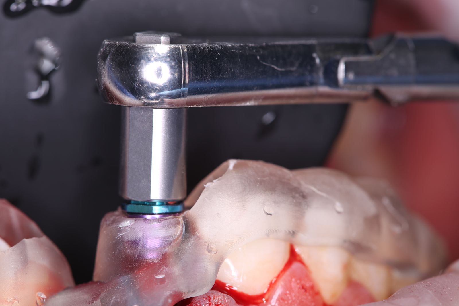 Case solved by Dental Design | Dynamic Abutment Solutions EN Case solved by Dental Design | Dynamic Abutment Solutions EN