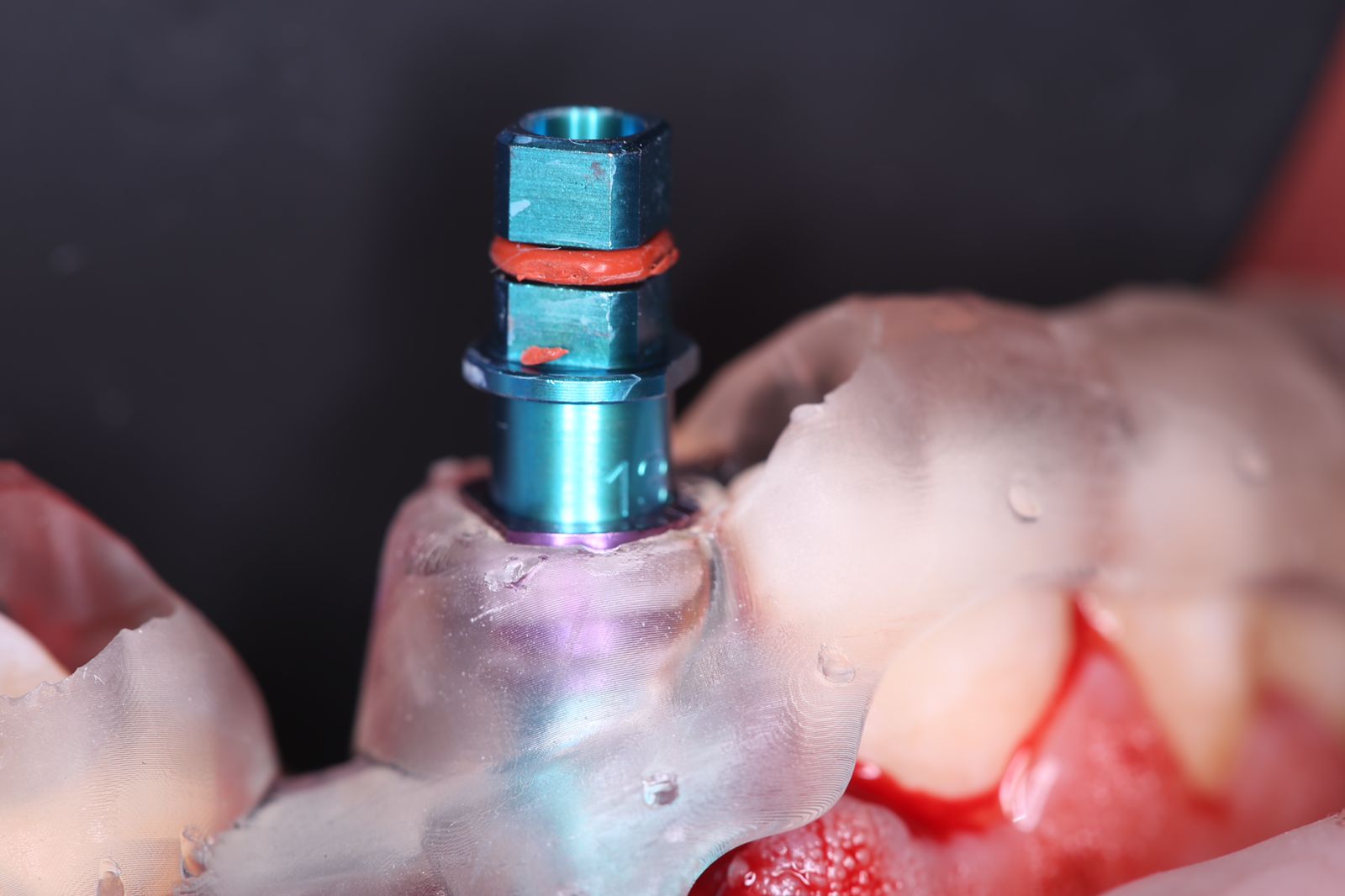 SURGICAL GUIDE DAS KIT and DAS MULTI-UNIT SYSTEM | Dynamic Abutment ...