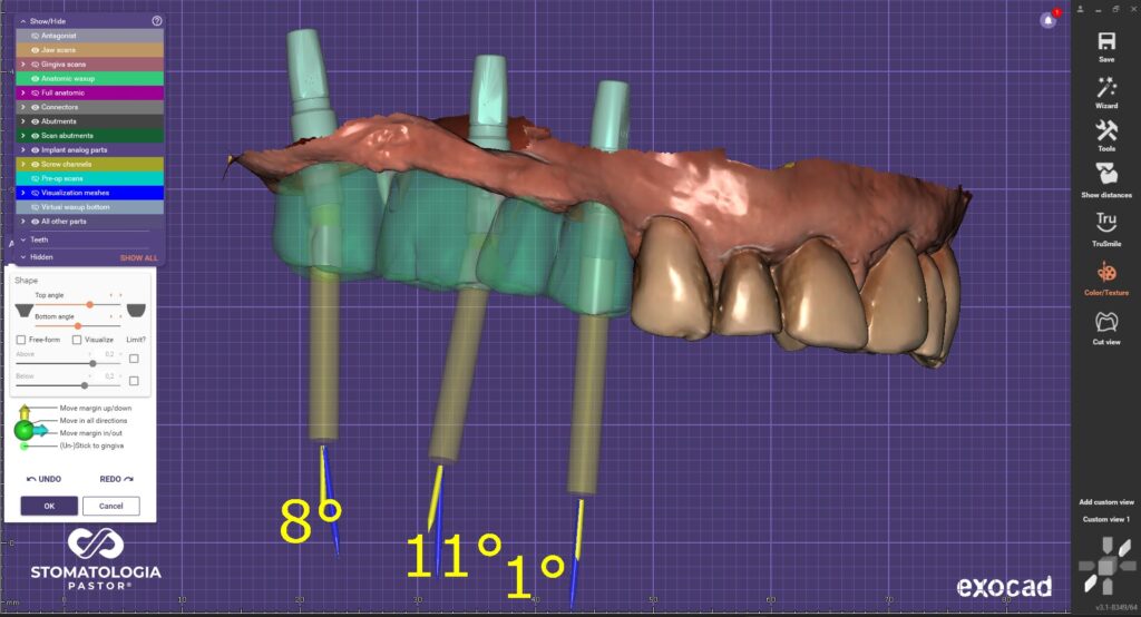 New case solved with the Guided DAS Surgical Kit | Dynamic Abutment ...