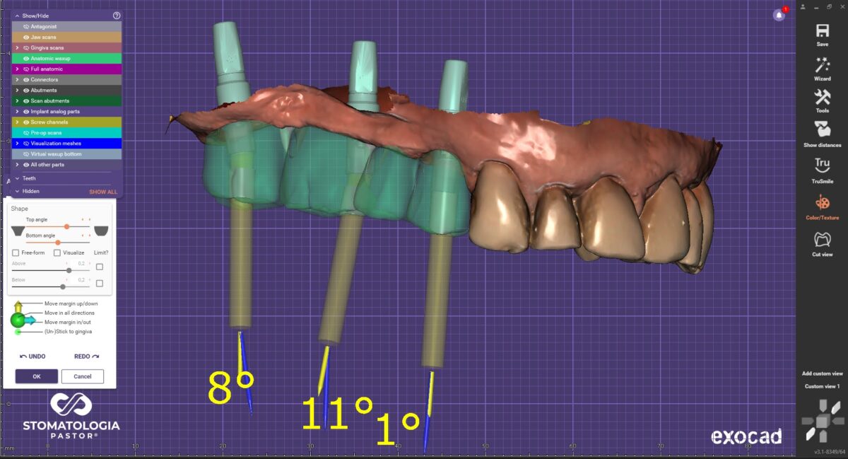 New case solved with the Guided DAS Surgical Kit | Dynamic Abutment ...