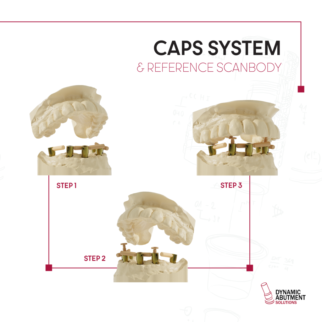 CAPS System | Dynamic Abutment Solutions EN