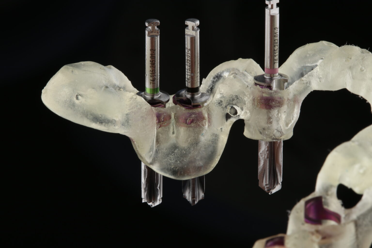 NEW case solved with our DAS Guided Surgical Kit | Dynamic Abutment ...